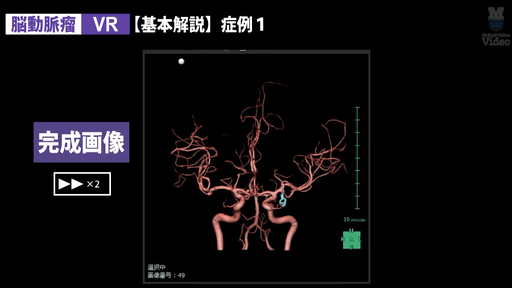 3D画像製作 脳動脈瘤 MPR・MIP・VR ｜ Medical*Online Video