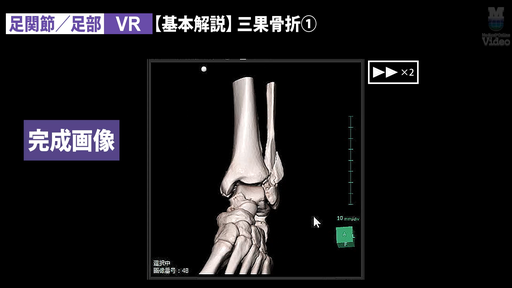 3D画像製作 足関節／足部 MPR・VR ｜ Medical*Online Video
